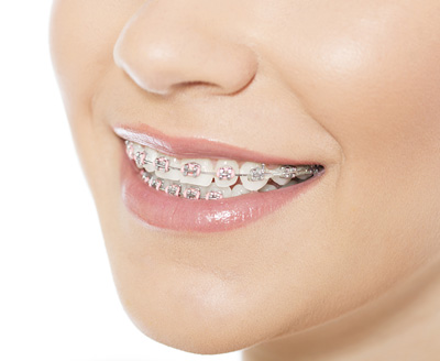 Types of Braces Tampa Miami Lakes FL | Torres Orthodontics